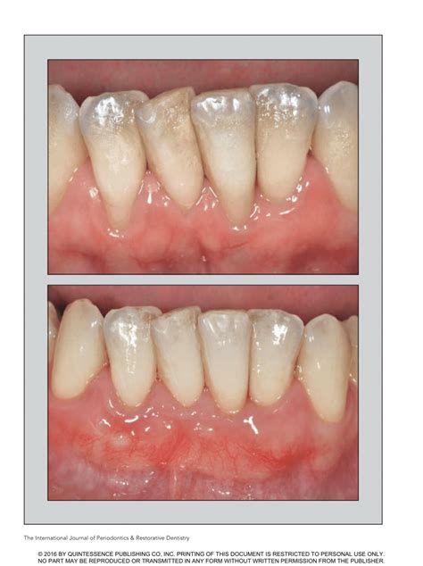 pdf coverage of multiple mandibular gingival recessions using tunnel