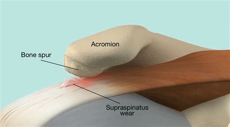 Bone Spurs On The Undersurface Of The Acromion May Create Impingement And Lead To Cuff Wear And