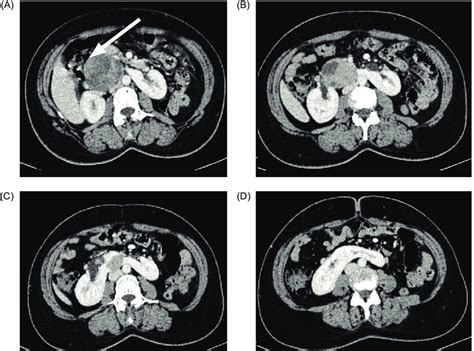 A D Axial Contrast Enhanced Ct Abdomen Showing Well Defined
