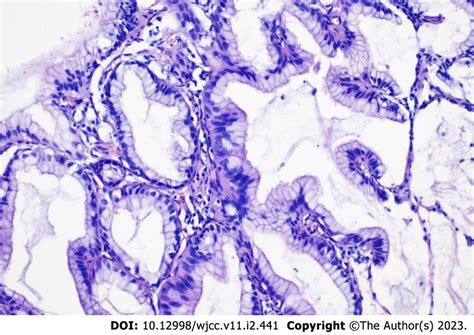 Histopathological Section Of Computed Tomography Guided Percutaneous Download Scientific