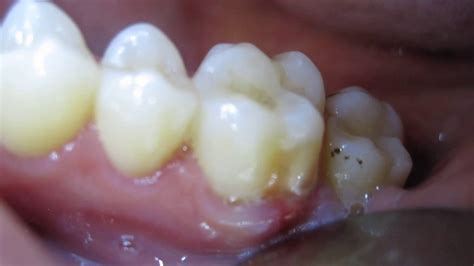 Disgusting Pus Filled Tooth Gum Boil Periodontal Abscess Youtube
