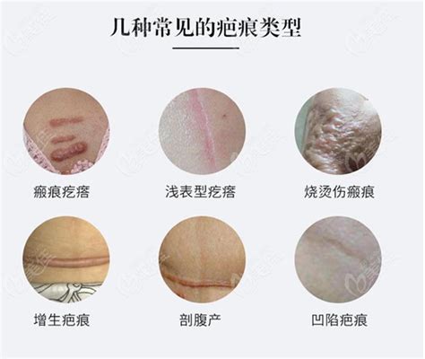 疤痕类型图介绍 正常 大山谷图库