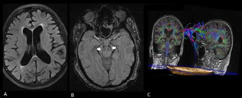 Mri Findings In Parkinson S Disease Radiographics