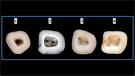 Mandibular First Molar Canals