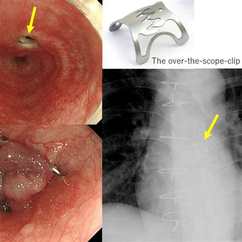 Intraoperative View Of Left Atrium Perforation A Perforation Of The Download Scientific