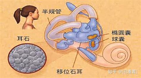 耳石什么样图片 耳石图片大全 耳石症动画演示 大山谷图库