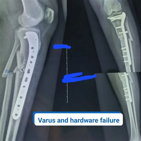 Mohammed Abdulal Hamad On Linkedin Proximal Tibia Extra Articular Fracture Proximal Tibia