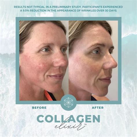 Collagen Elixir Before And Afters Isagenix Collagen Isagenix Photo Sharing