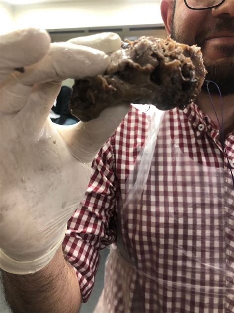 Right Total Maxillectomy And Partial Left Maxillectomy Showing A Fungating… Omar Anwar Tawfik Md