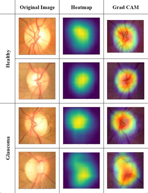 Glaucoma Fundus