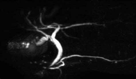 Preoperative Magnetic Resonance Cholangiopancreatography MRCP No Download Scientific Diagram