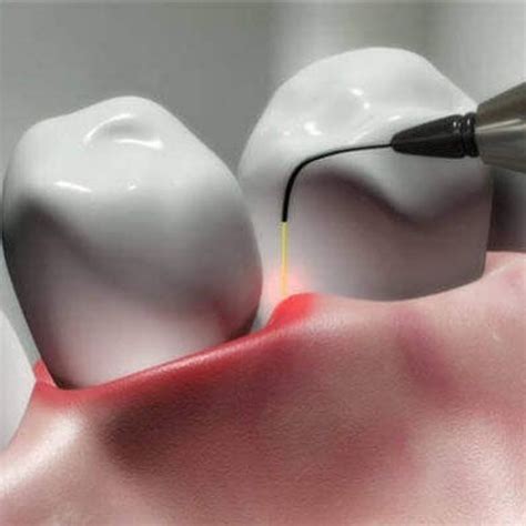 Laser Gum Surgery Manhattan Periodontics And Implant Dentistry