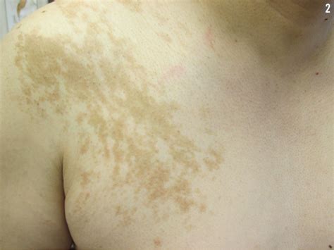 Focal Hyperpigmentation