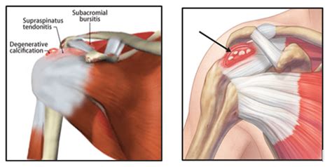 Calcific Tendinopathy Lg Physiotherapy