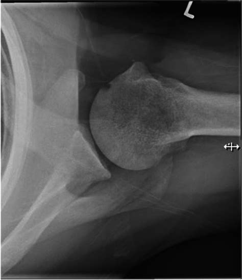 Correctly Positioned Superiorinferior Axial Shoulder Using The Lewis