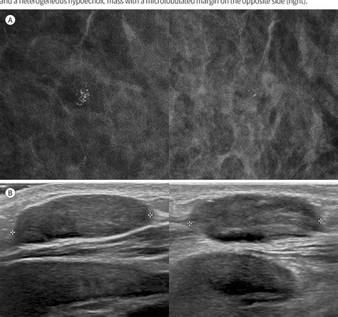 Figure 1 From Concurrent Invasive Carcinoma And Fibroadenoma Arising From Bilateral Ectopic
