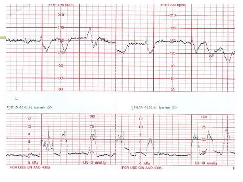 Cardiotocography Ctg Ppt
