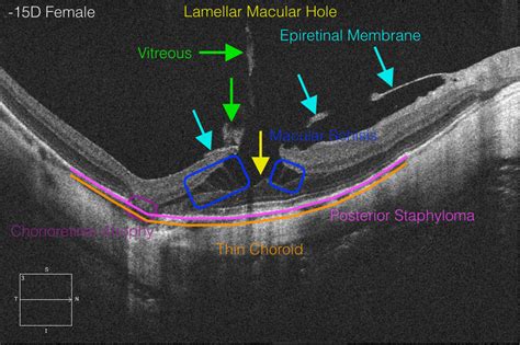 High Myopia Plus Lamellar Macular Hole Eyecarepd