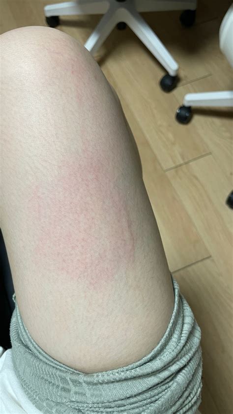 입술 붓기 허벅지 피부 가려움 지식in