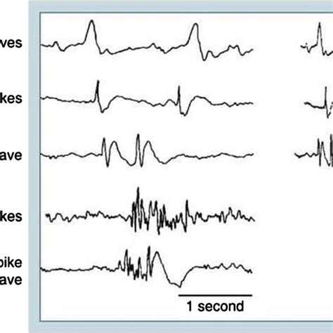 Output Waveform Of An Epileptic Eeg Wave Before Filtering Download
