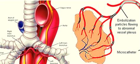 Bronchial Artery Clinical Pulmonary Artery Catheter