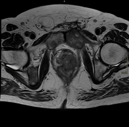 Prostate Cancer T Rectal Invasion Radiology Case Radiopaedia Org