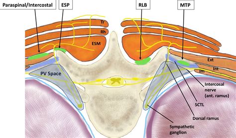 Paravertebral By Proxy Time To Redefine The Paravertebral Block Costache 2018