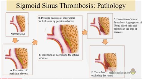 Sigmoid Sinus Thrombosis In Otolaryngology Pdf
