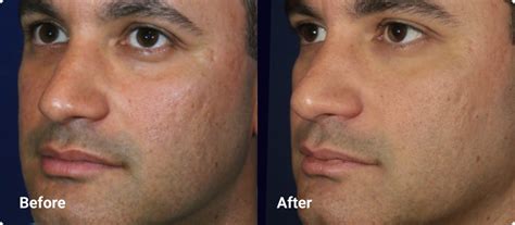 Sofwave Ultrasound Skin Tightening