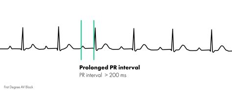 Prolonged Pr Interval
