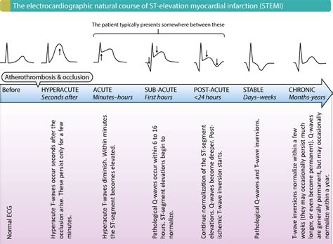 acute mi ecg tracing