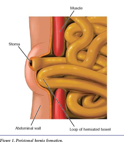 Table 2 From Parastomal Hernia Incidence Prevention And Treatment