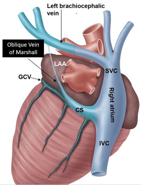 What To Expect After Pvi Ablation At Nicholas Ratcliffe Blog