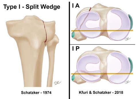 Radiopaedia Case Kfuri And Schatzker Classification Of Tibial Plateau