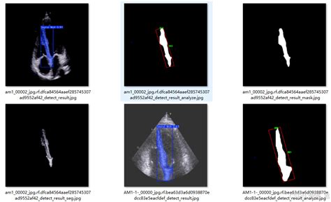 基于yolo11深度学习的心脏超声图像间隔壁检测分割与分析系统【python源码pyqt5界面数据集训练代码】深度学习实战、目标分割