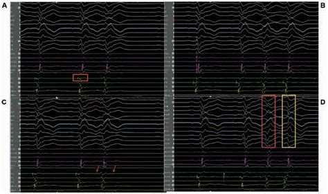 Figure 5 From The Initial Part Of Polymorphic Ventricular Tachycardia
