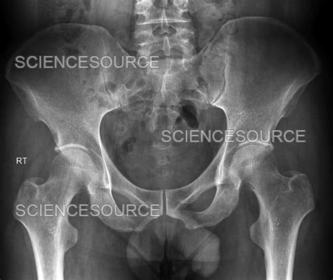 Normal Pelvis X Ray Film X Ray Normal Pelvis By Puwadol