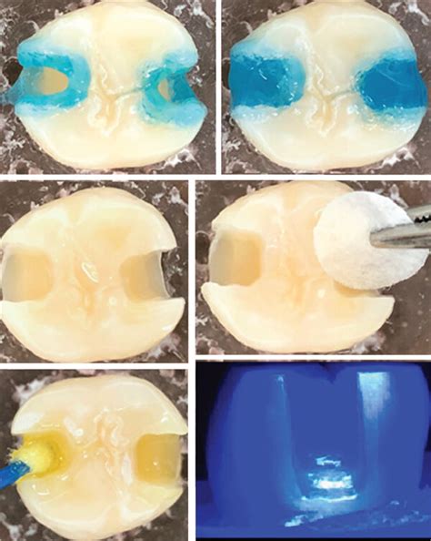 What Does Total Etch Mean At David Meza Blog