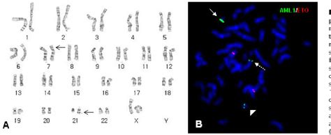 Figure 1 From A Novel Translocation Involving RUNX1 And HOXA Gene Clusters In A Case Of Acute