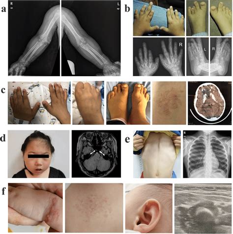 Pseudohypoparathyroidism Face