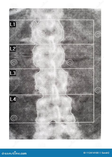 Bone Density DEXA Scan Osteoporosis Diagnosis Stock Photography CartoonDealer Com