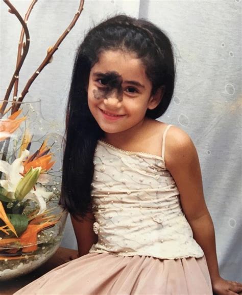 Girl Was Teased Because Of A Birthmark But Now She Is A Model And