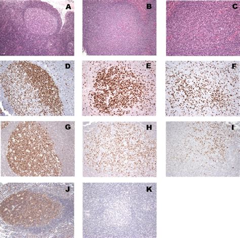 Histopathology Of The Patient Lymph Node As Compared With A Reactive Download Scientific