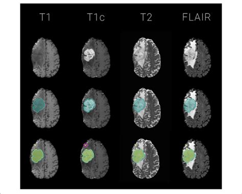 Exemplary Glioma Segmentation Exam With Multi Modal Mr Segmentations Download Scientific