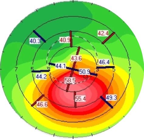 Keratoconus And Corneal Cross Linking Brisbane — Qei Laser · Laser Eye