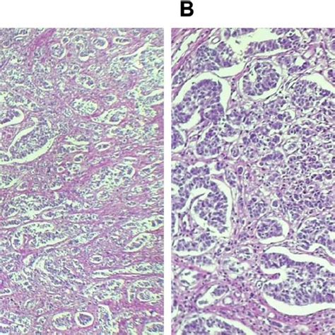 Hande Vermiform Appendix A 4× Exhibits Organoid And Trabeculated