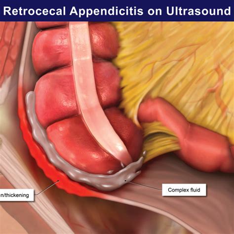 Medical Legal Exhibits Legal Animations And Trial Graphics