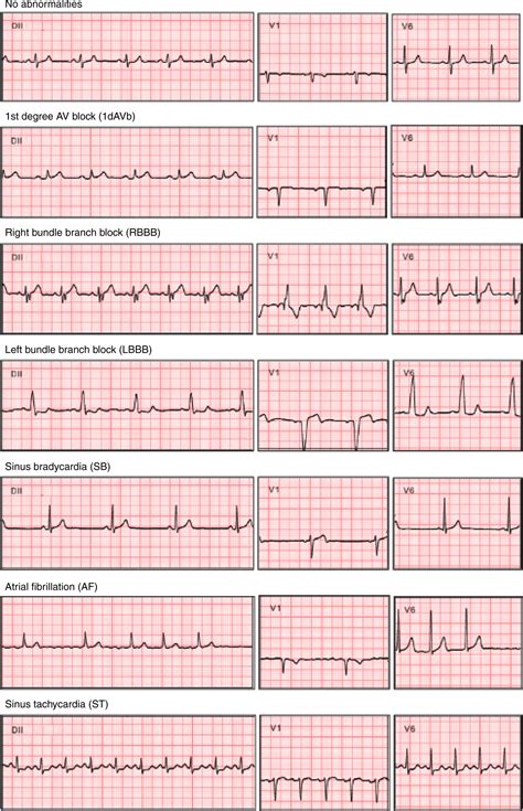 Github Antonior92automatic Ecg Diagnosis Scripts And Modules For