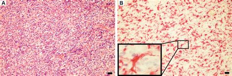 Histology A And Immunohistology Of Slices From Gist Tissue For