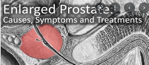 Shrink Your Prostate In A Matter Of Seconds Net Patient Foundation